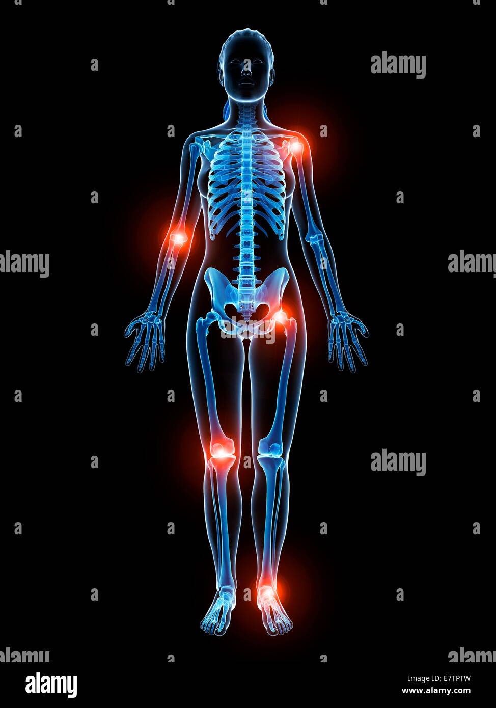 Human joint pain, computer artwork Stock Photo - Alamy