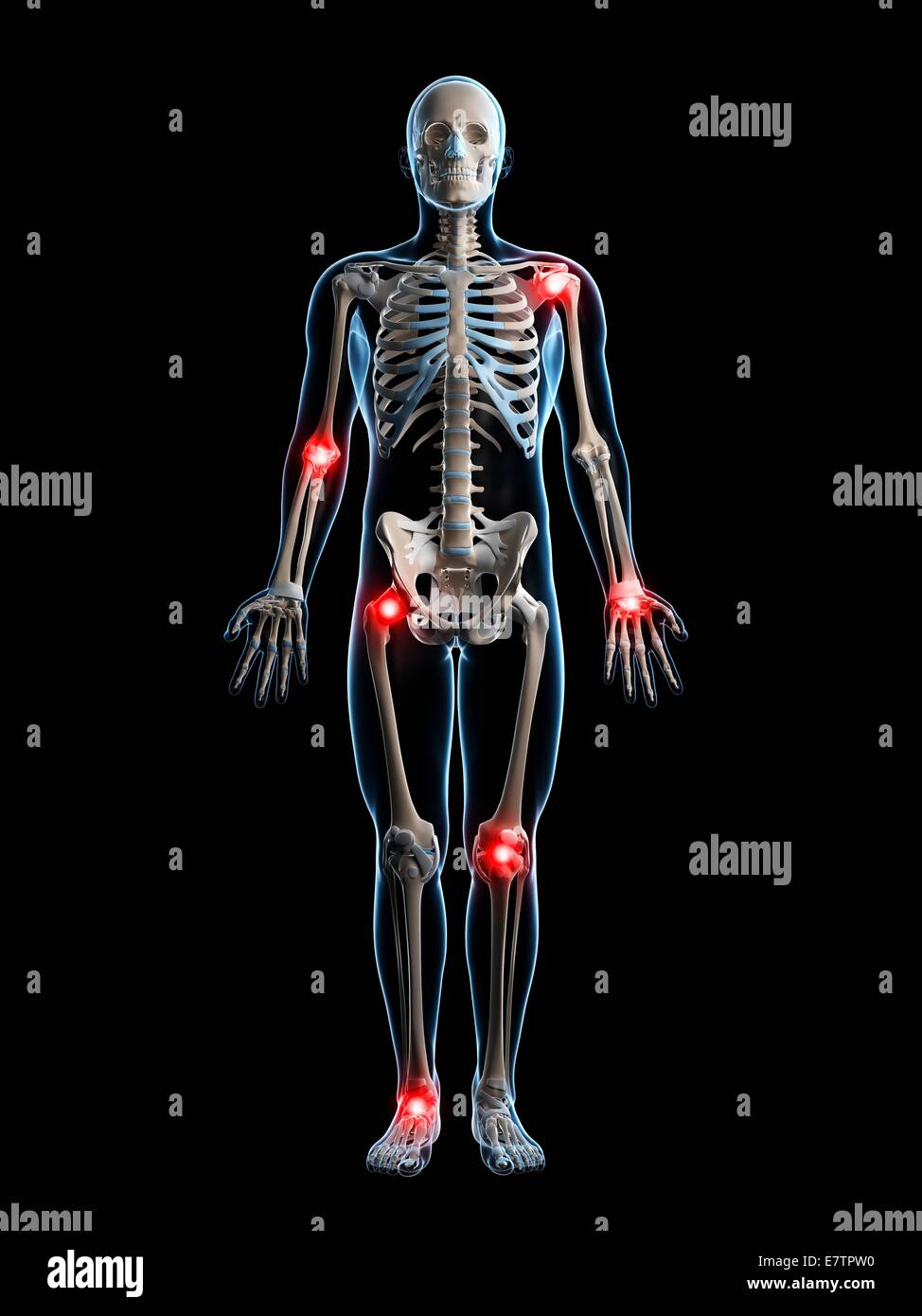 Human joint pain, computer artwork Stock Photo - Alamy