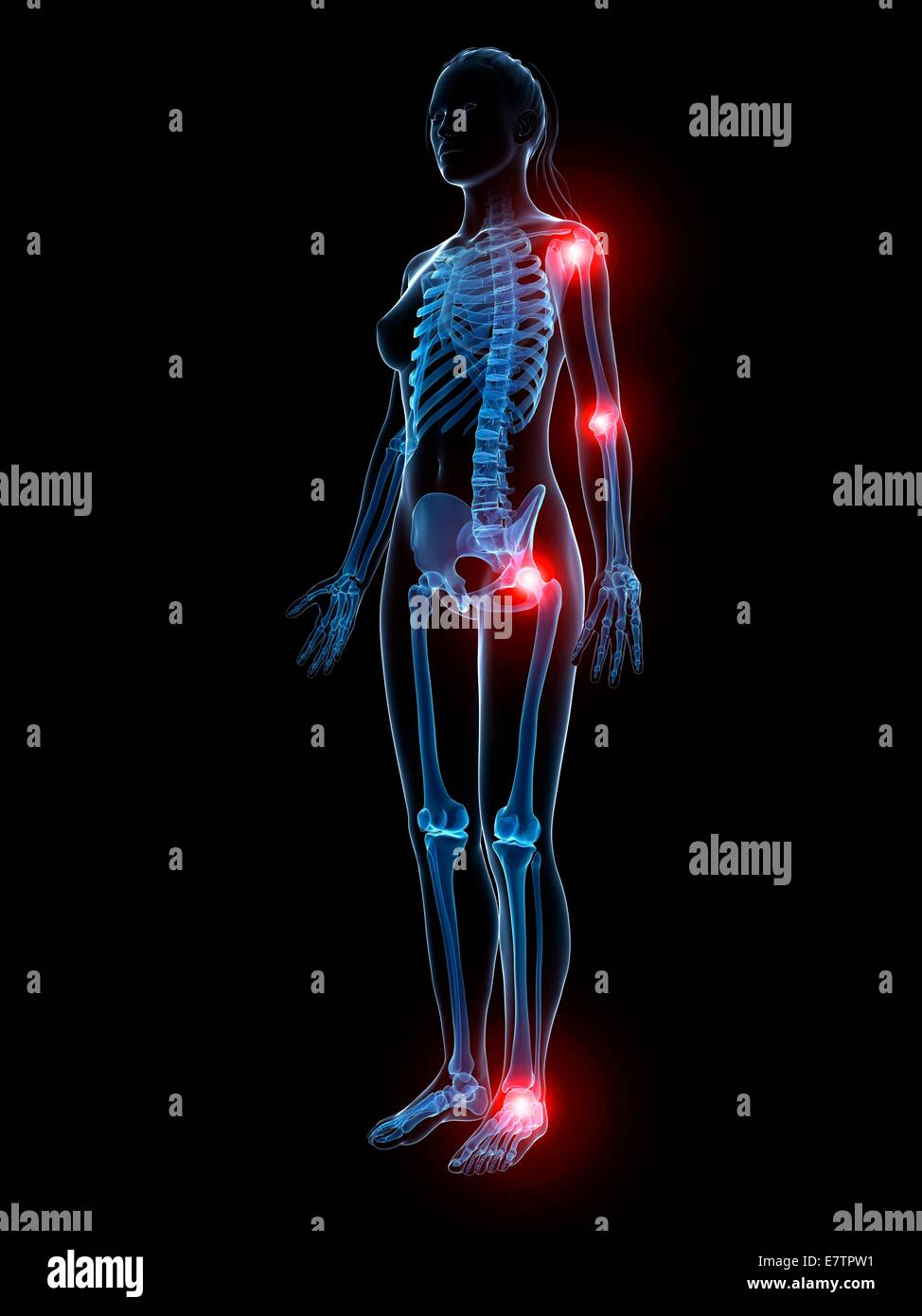 Human joint pain, computer artwork Stock Photo - Alamy