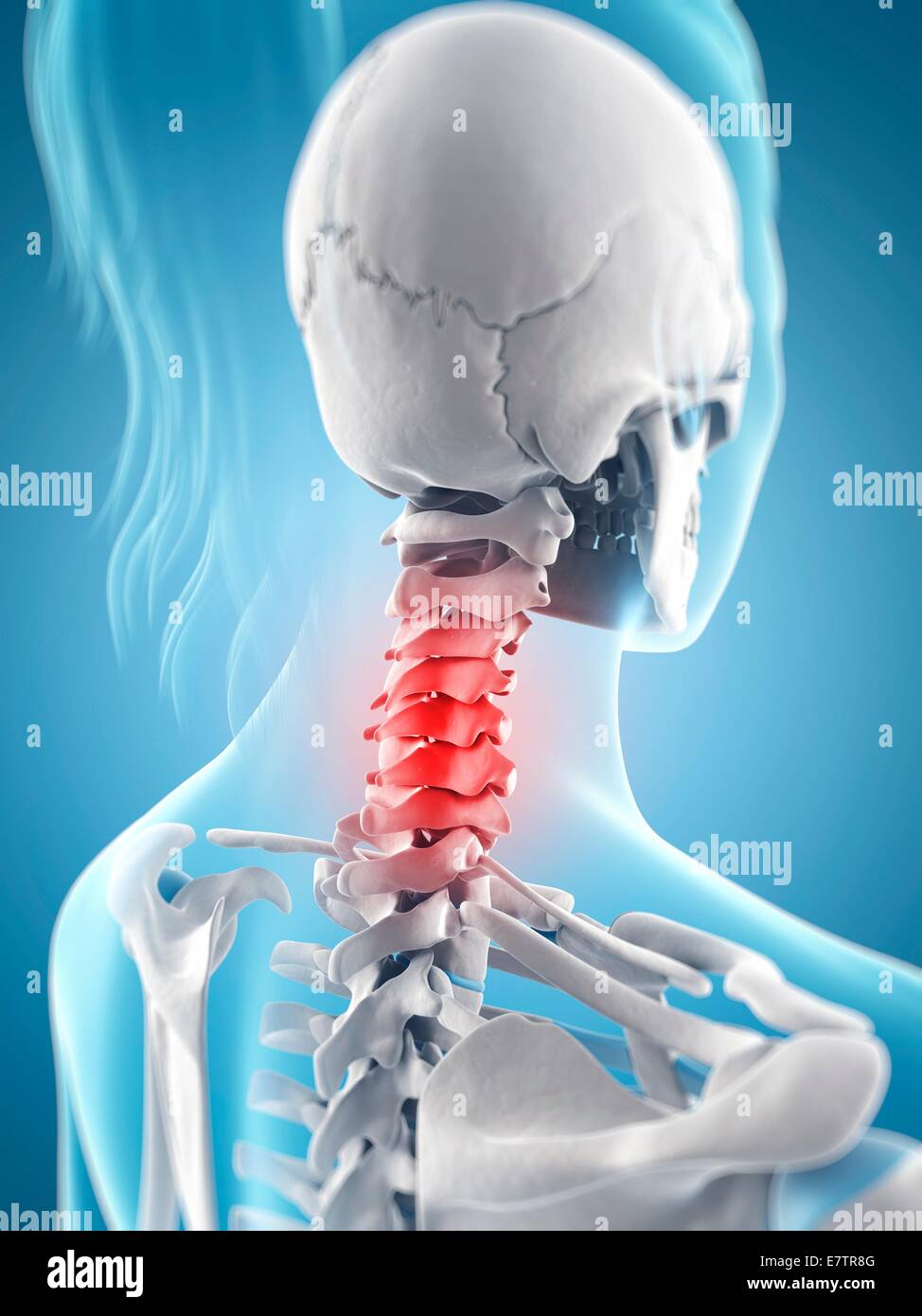 Neck pain computer artwork hi-res stock photography and images - Alamy