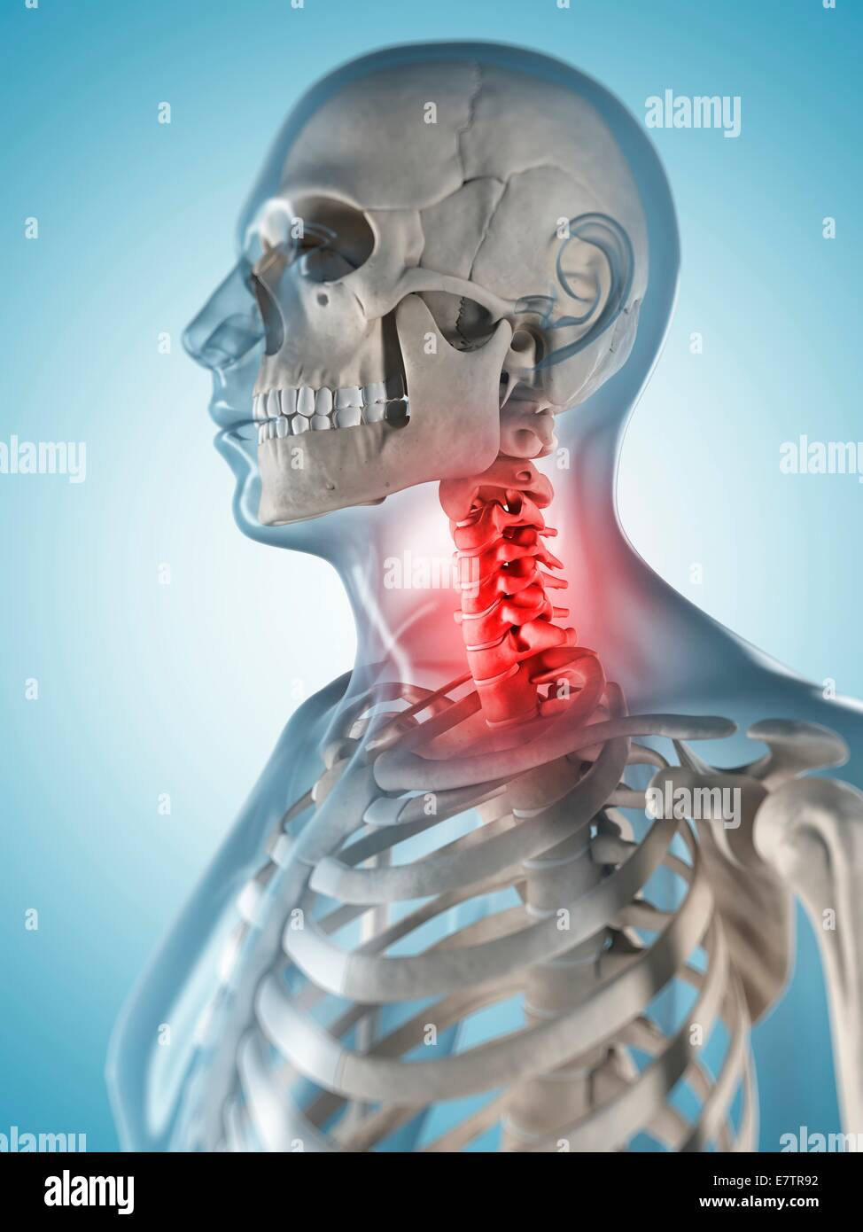Neck pain computer artwork hi-res stock photography and images - Alamy