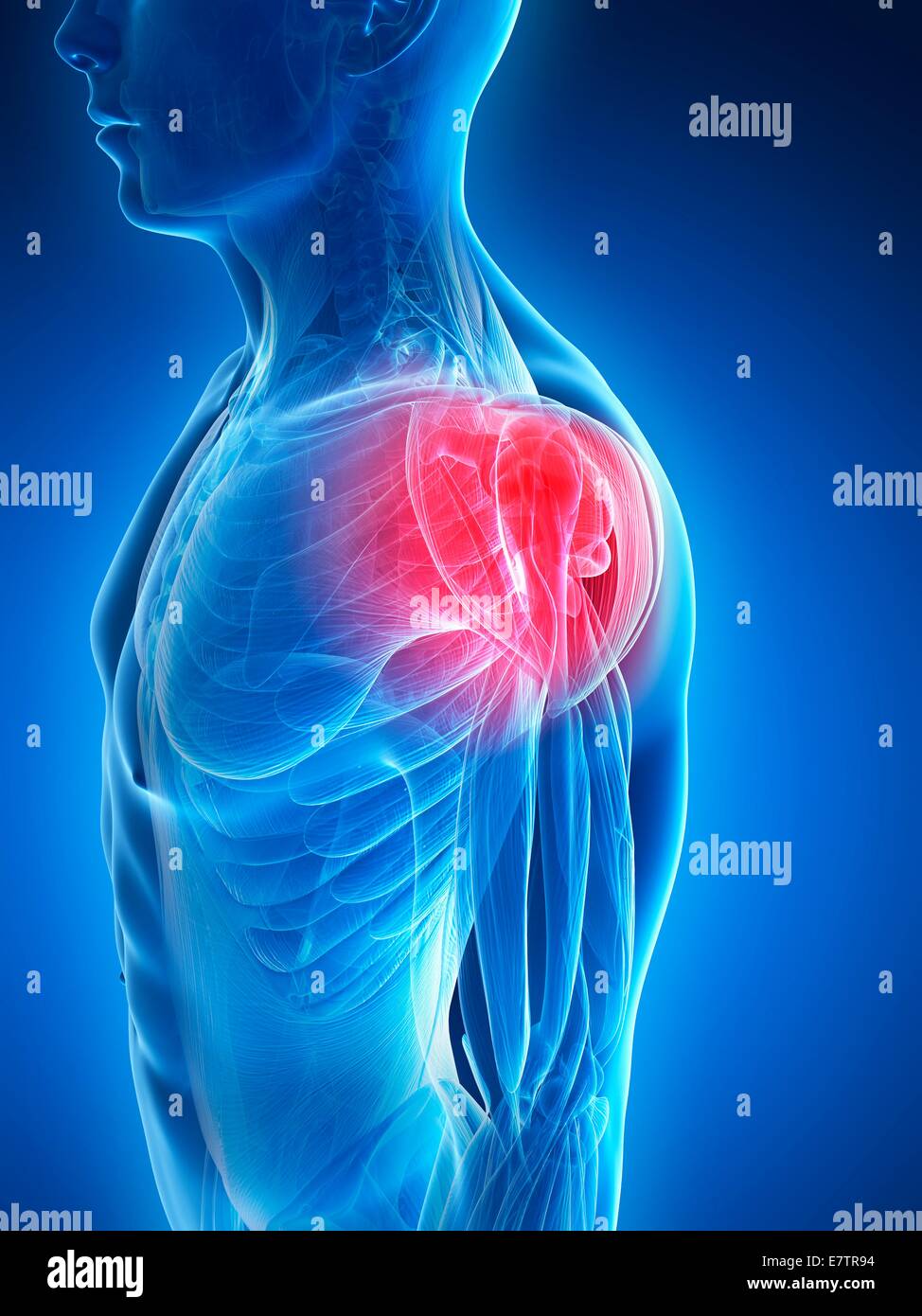 Human shoulder pain, computer artwork Stock Photo - Alamy