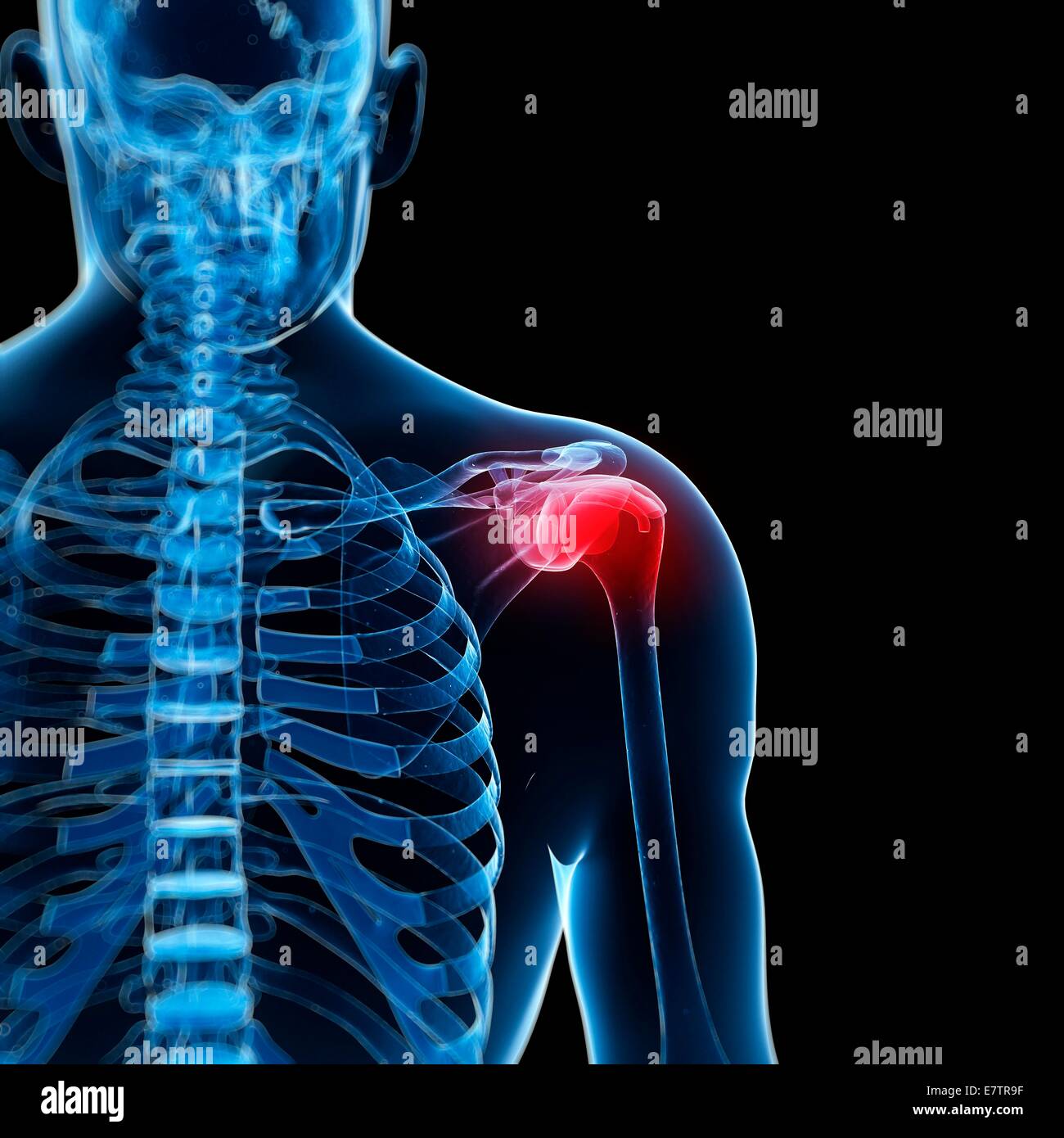 Human shoulder pain, computer artwork Stock Photo - Alamy