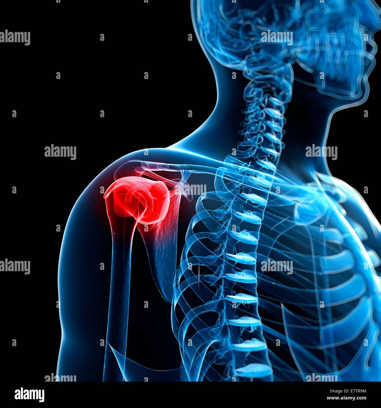 Shoulder pain and computer hi-res stock photography and images - Alamy