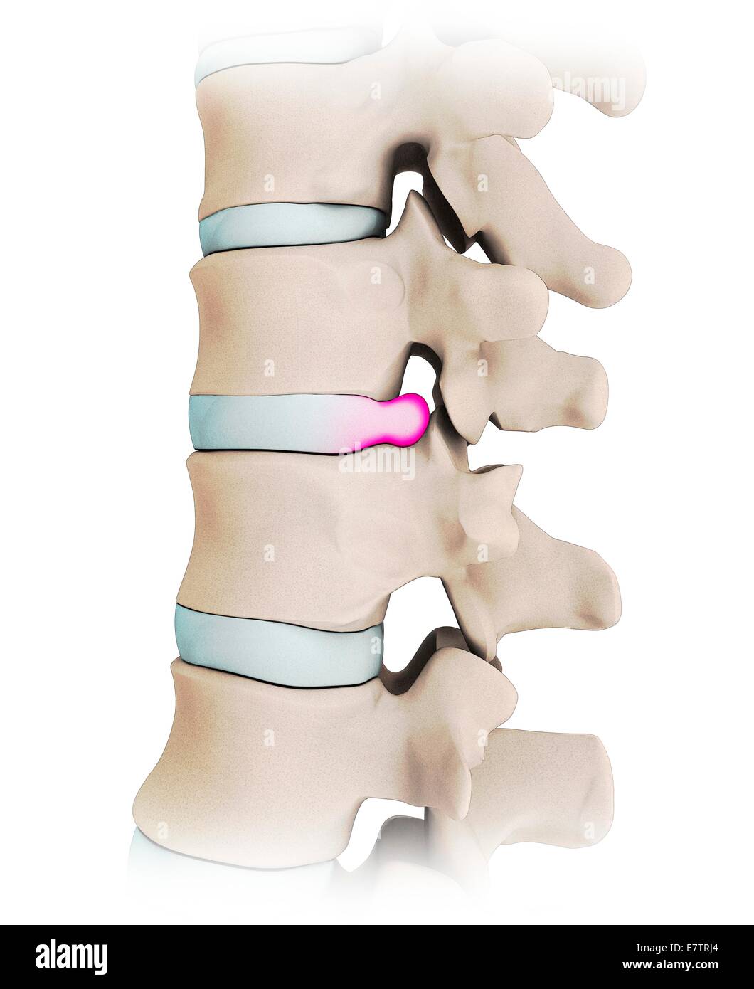 Human spine with slipped disc, computer artwork Stock Photo - Alamy