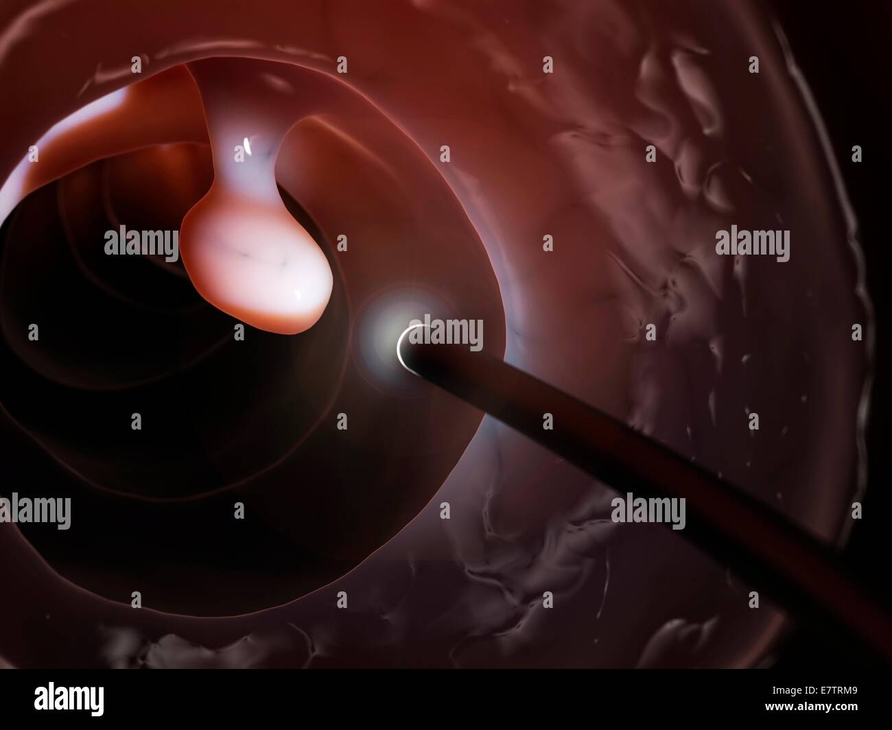 Colonoscopy hi-res stock photography and images - Alamy