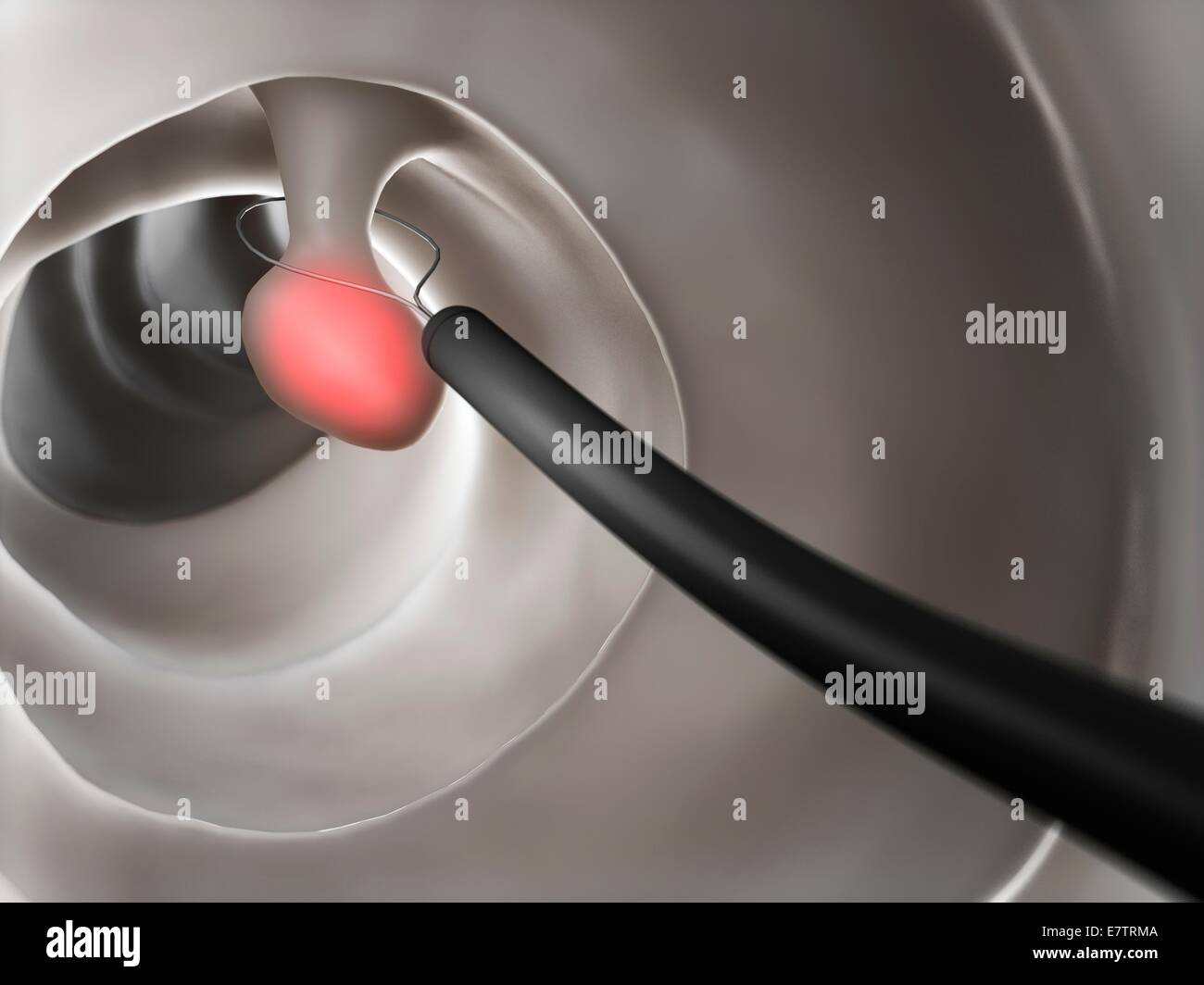 Colon polyp hi-res stock photography and images - Alamy