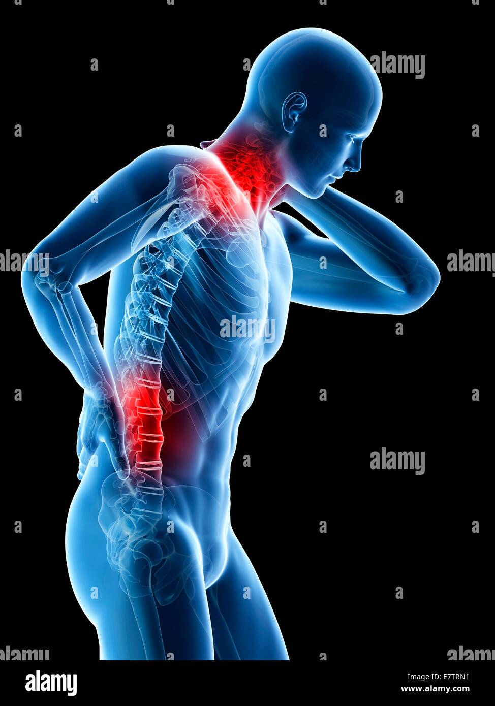 Human neck and back pain, computer artwork Stock Photo - Alamy