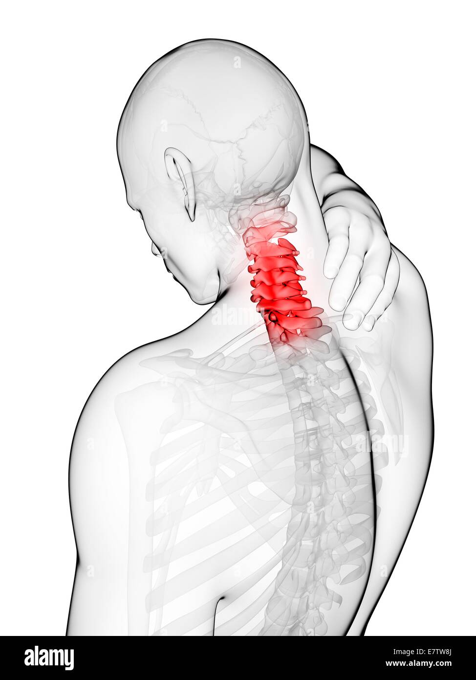 Human neck pain, computer artwork Stock Photo - Alamy