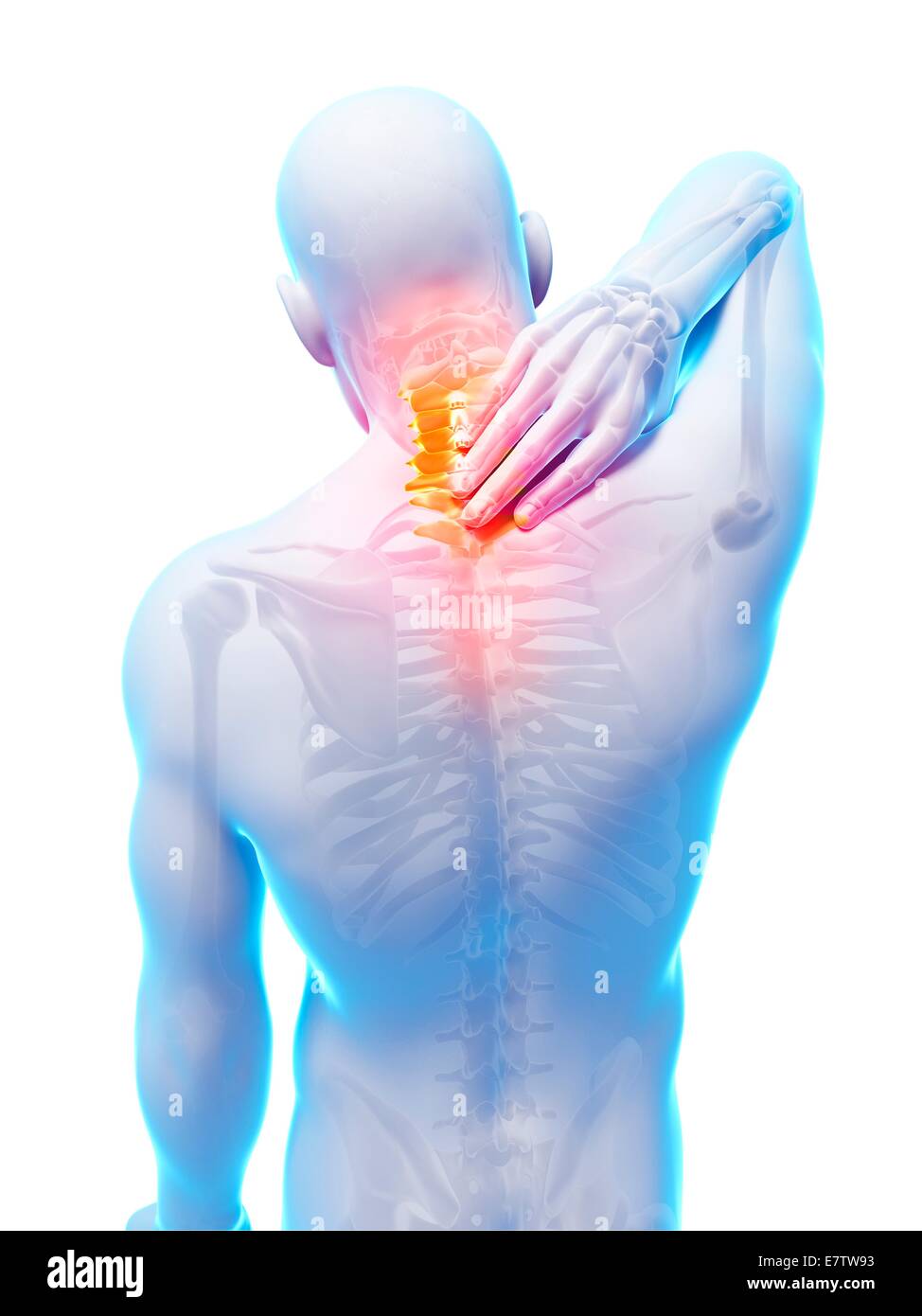 Human neck pain, computer artwork Stock Photo - Alamy