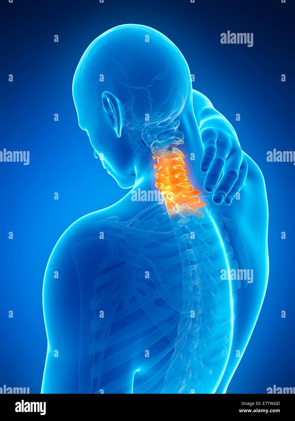 Human neck pain, computer artwork Stock Photo - Alamy