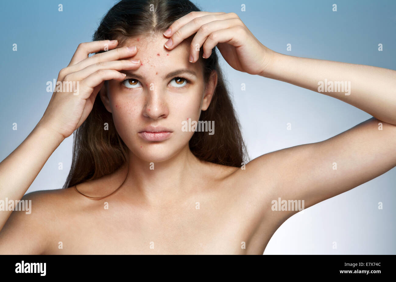 Teen skin problem hi-res stock photography and images - Alamy
