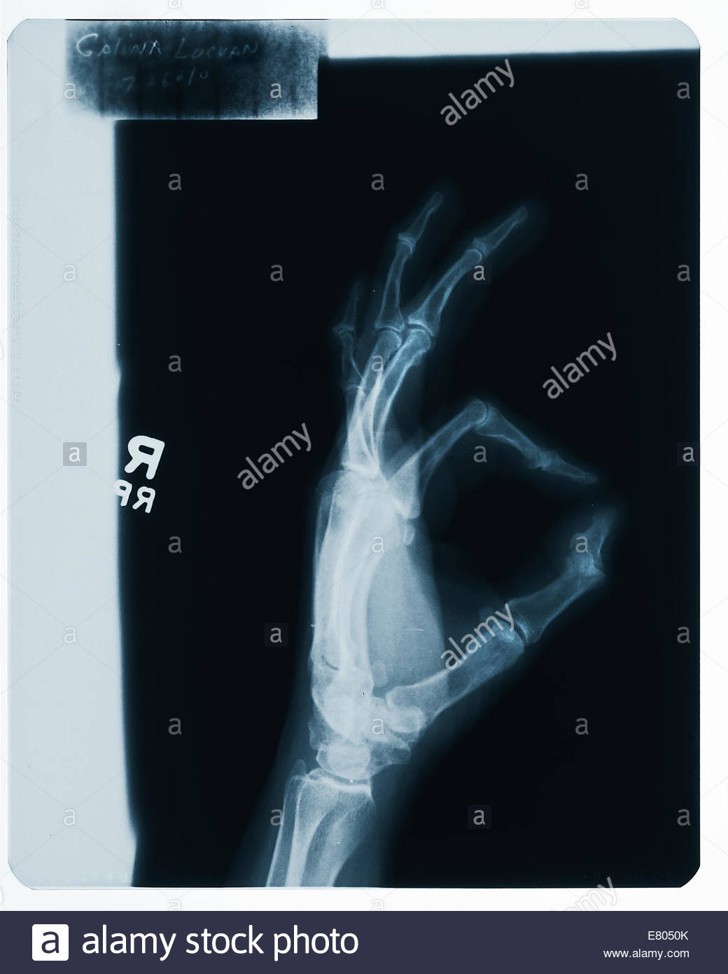 Broken Hand X Ray Stock Photos & Broken Hand X Ray Stock Images - Alamy