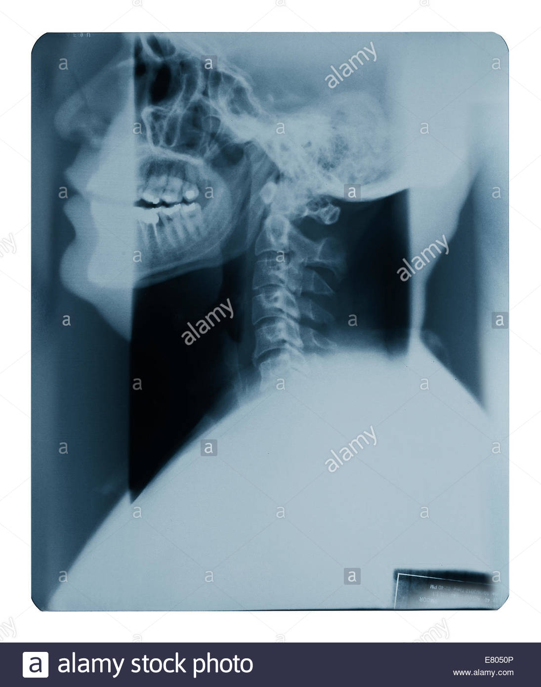 X Rays Of Body Parts Stock Photos & X Rays Of Body Parts Stock Images ...