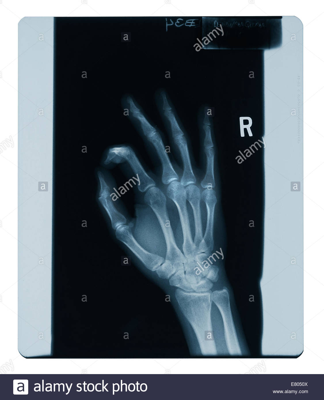 Broken Hand X Ray Stock Photos & Broken Hand X Ray Stock Images - Alamy