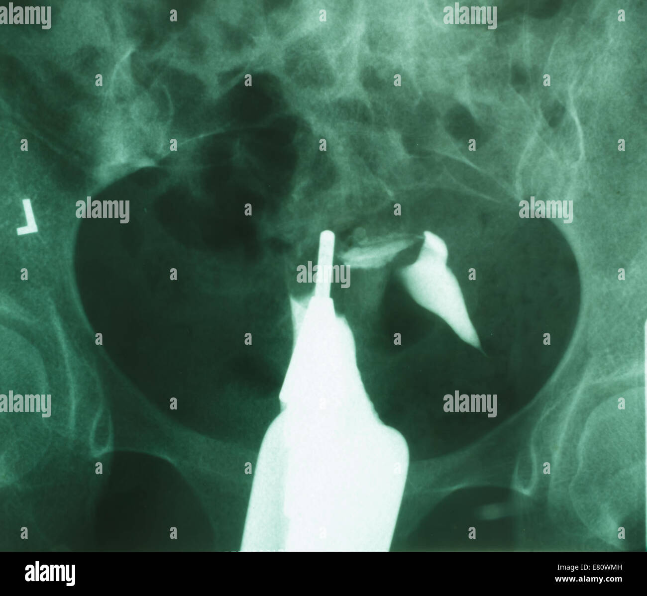 Ray film pelvis health hi-res stock photography and images - Alamy