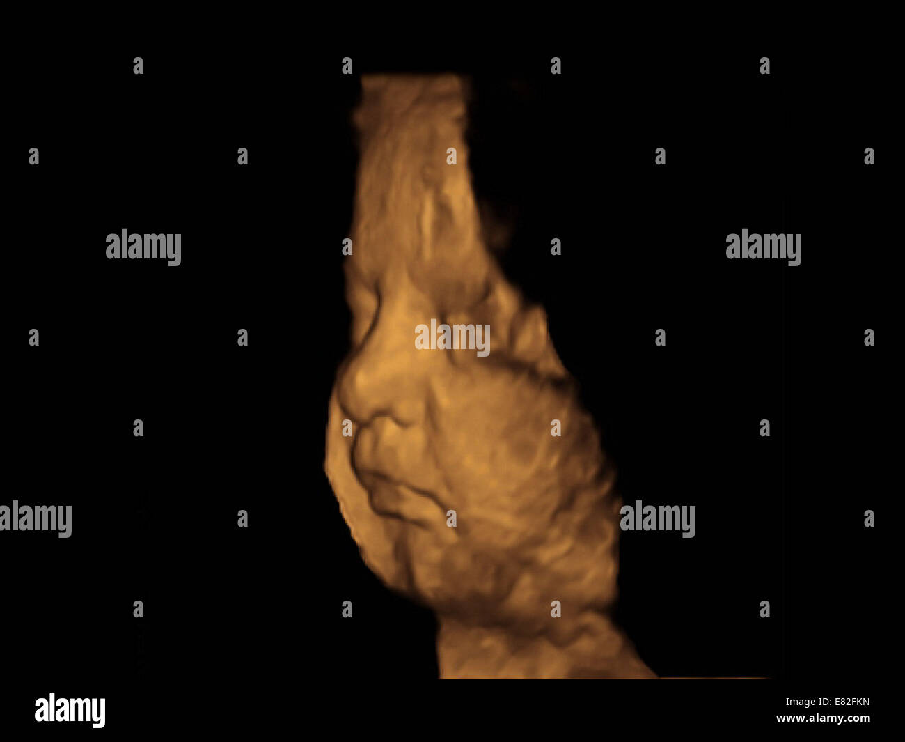 3d Ultrasound 32 Weeks