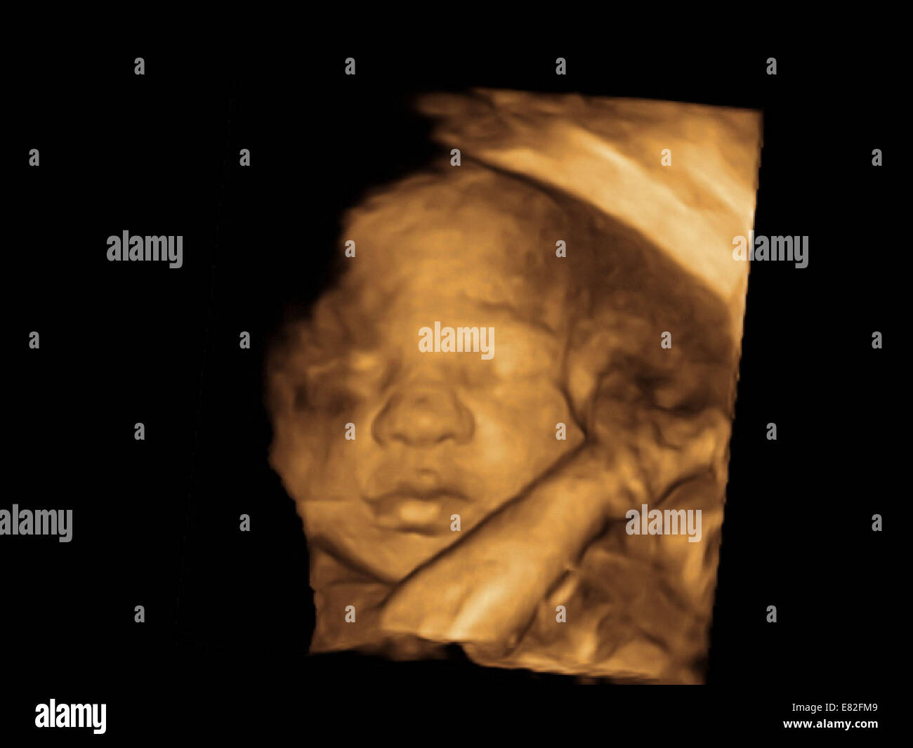 Foetus' face, Coloured 3-D ultrasound scan of a foetus, Gestational age ...