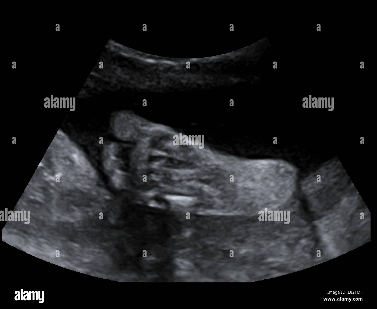 32 Weeks Ultrasound