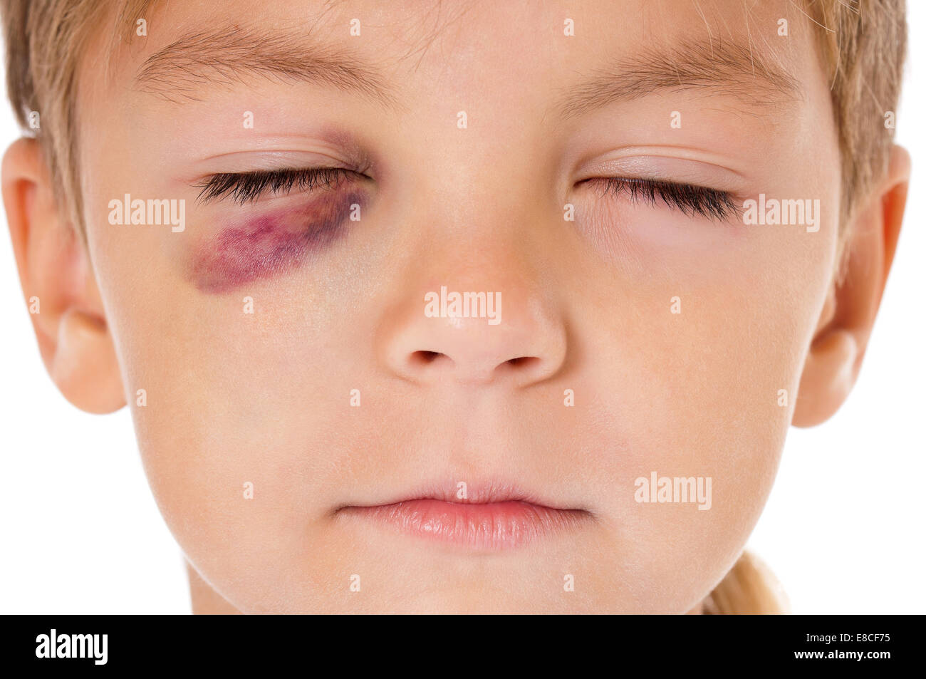 Boy with bruise Stock Photo - Alamy