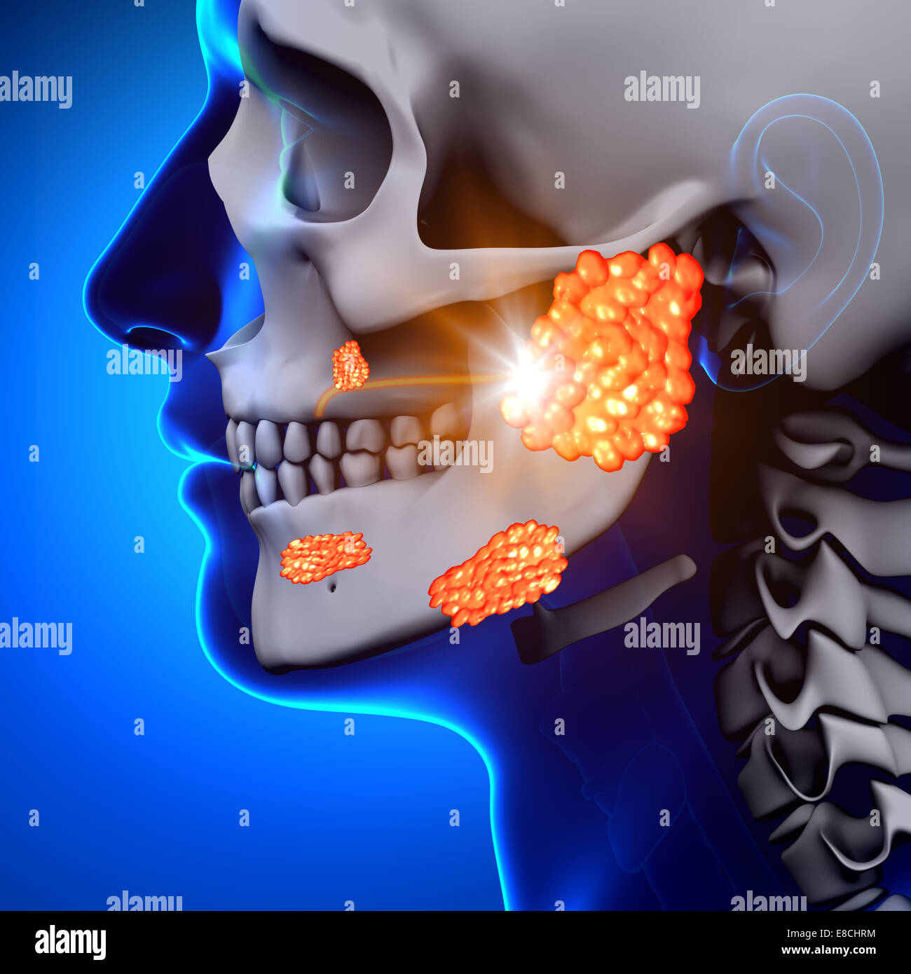 Mumps / Parotid Gland - Sickness Stock Photo - Alamy