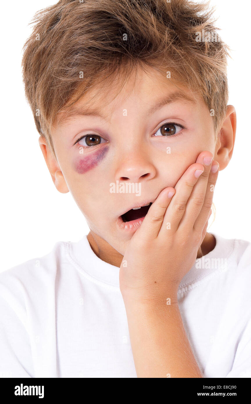 Boy with bruise Stock Photo - Alamy
