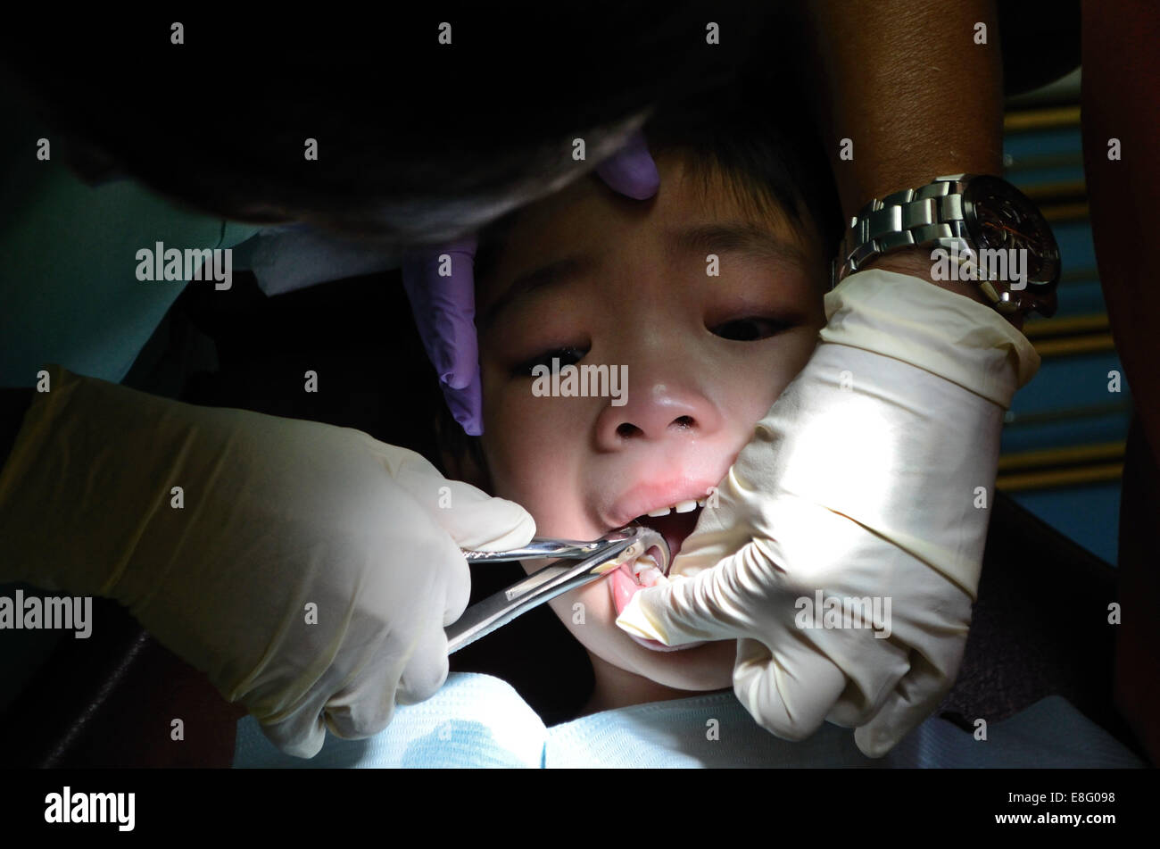Dentist Pulling Tooth High Resolution Stock Photography and Images - Alamy