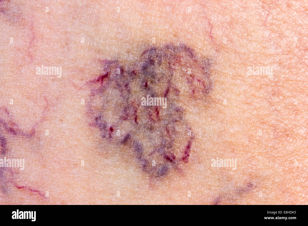 Varicose hi-res stock photography and images - Alamy