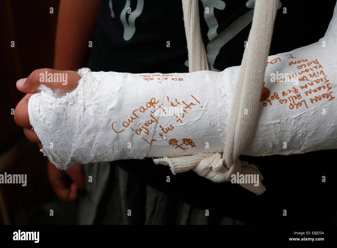 Arm In Plaster Stock Photos & Arm In Plaster Stock Images - Alamy