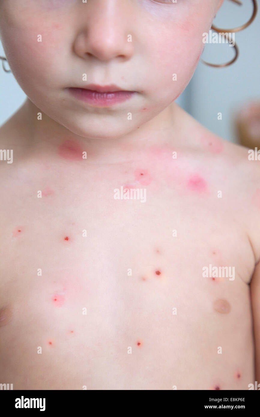 Girl Chickenpox Spots Stock Photos & Girl Chickenpox Spots Stock Images ...