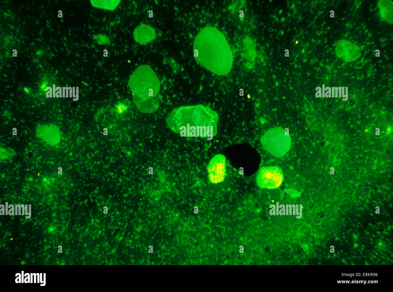 Here we see Mycobacterium tuberculosis in sputum smear is stained using fluorescent acid-fast ...