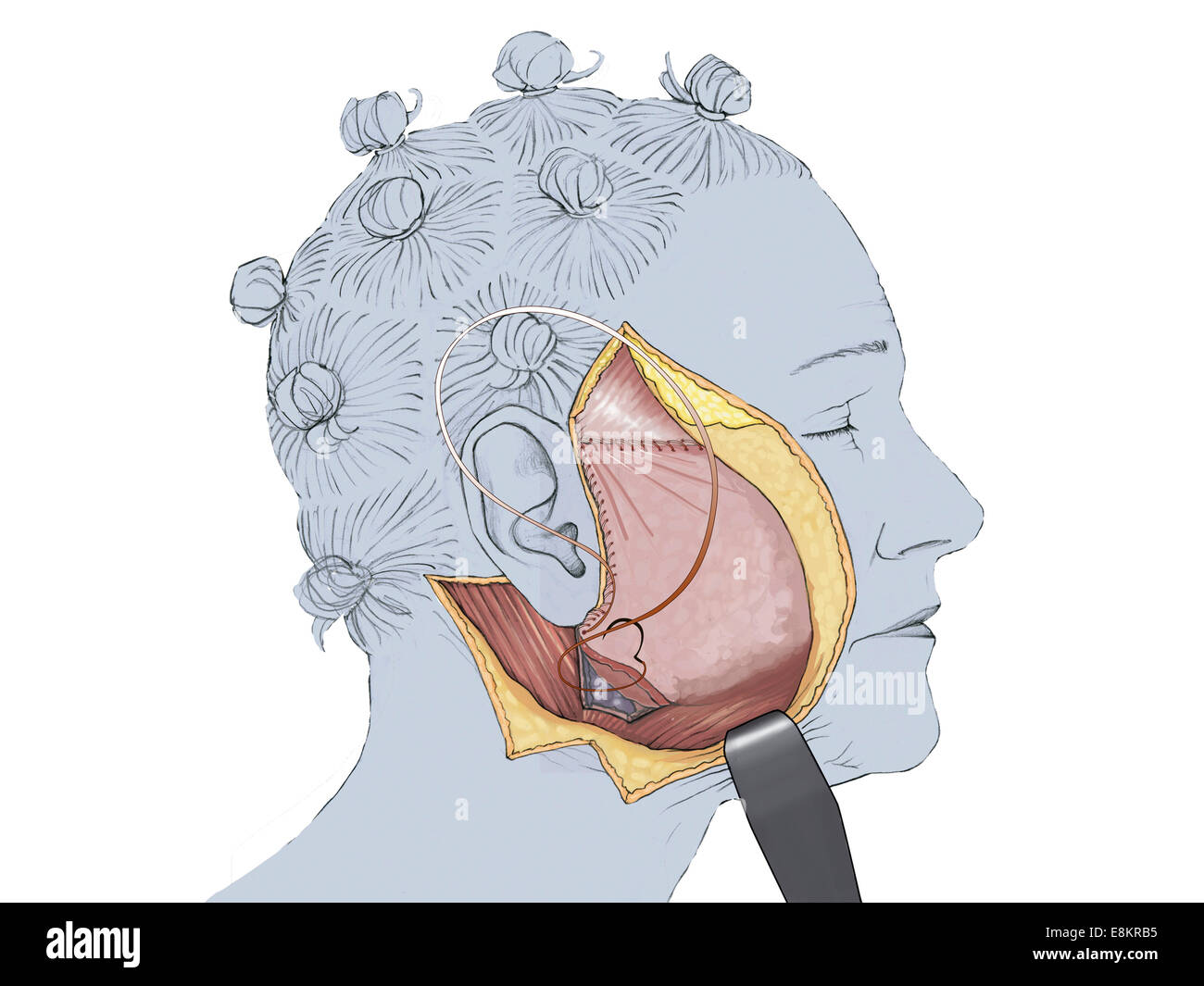 Cervico-facial lift, suture Stock Photo, Royalty Free Image: 74194153 ...