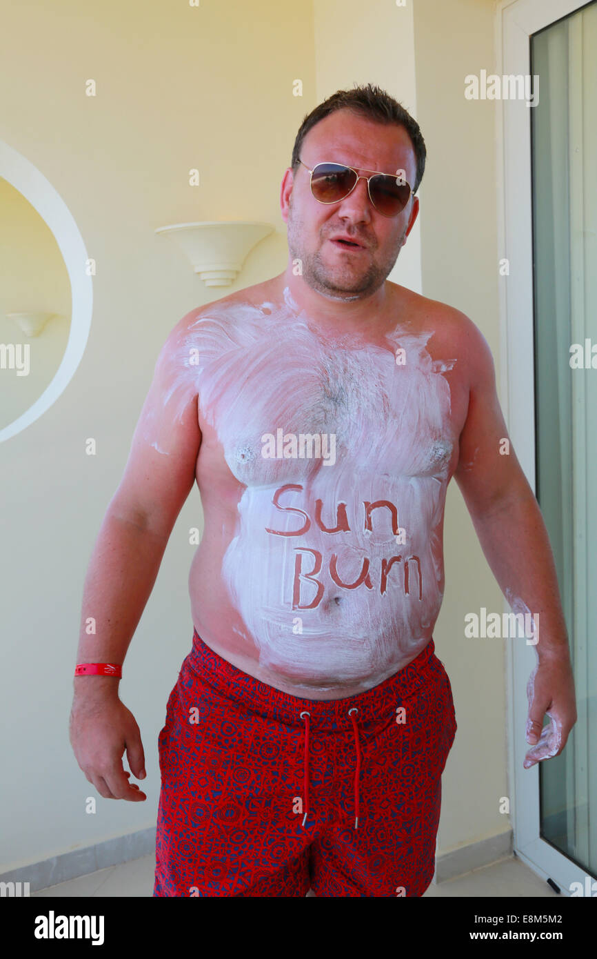 Bad sunburn hi-res stock photography and images - Alamy