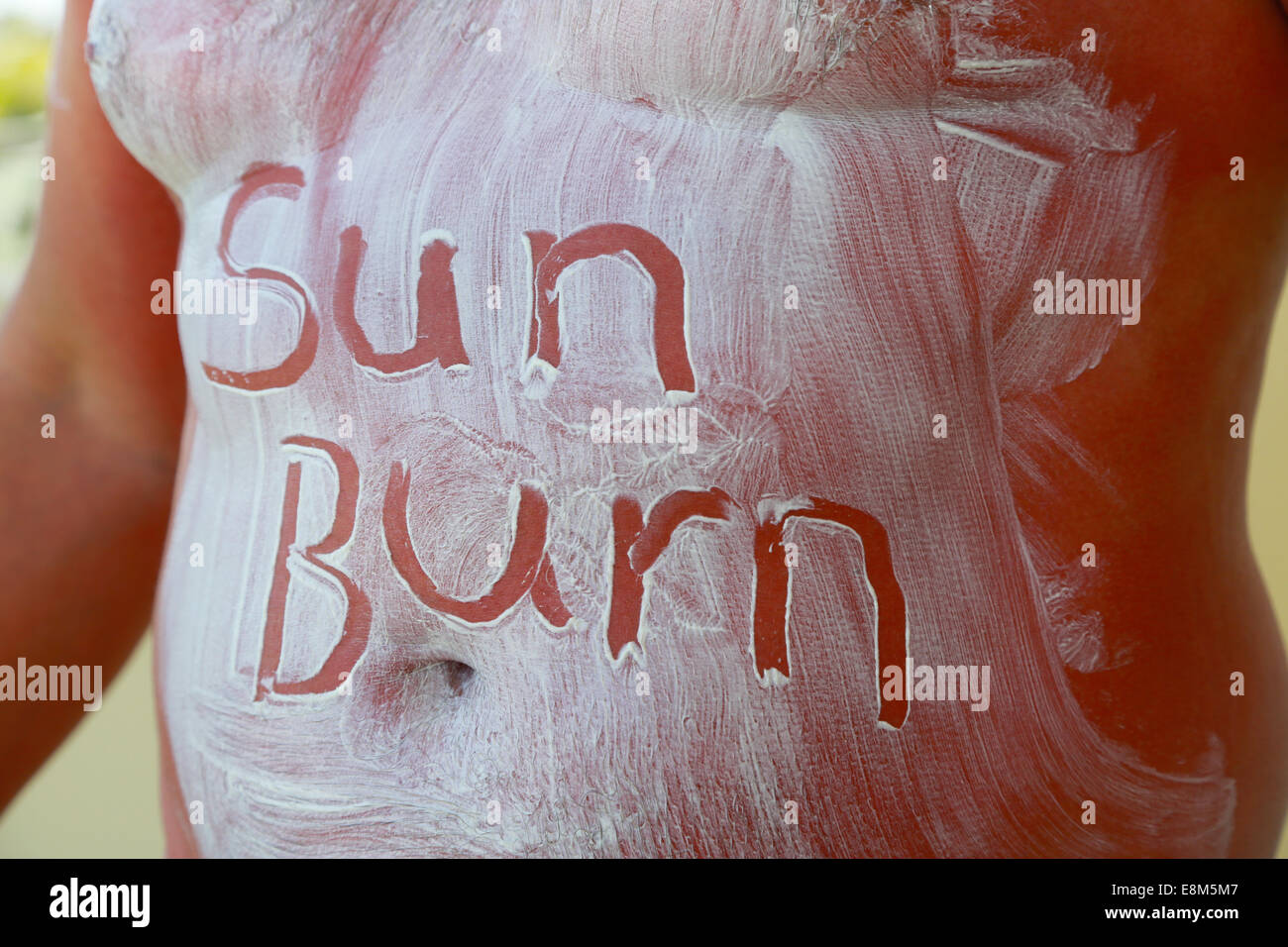 Bad sunburn hi-res stock photography and images - Alamy