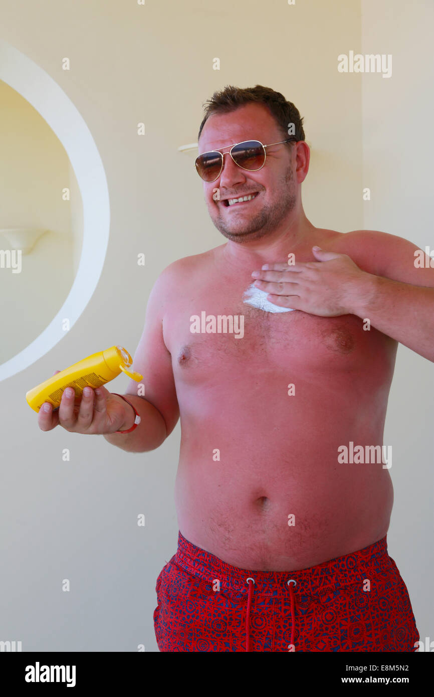 Very sun burnt man applying cream Stock Photo - Alamy
