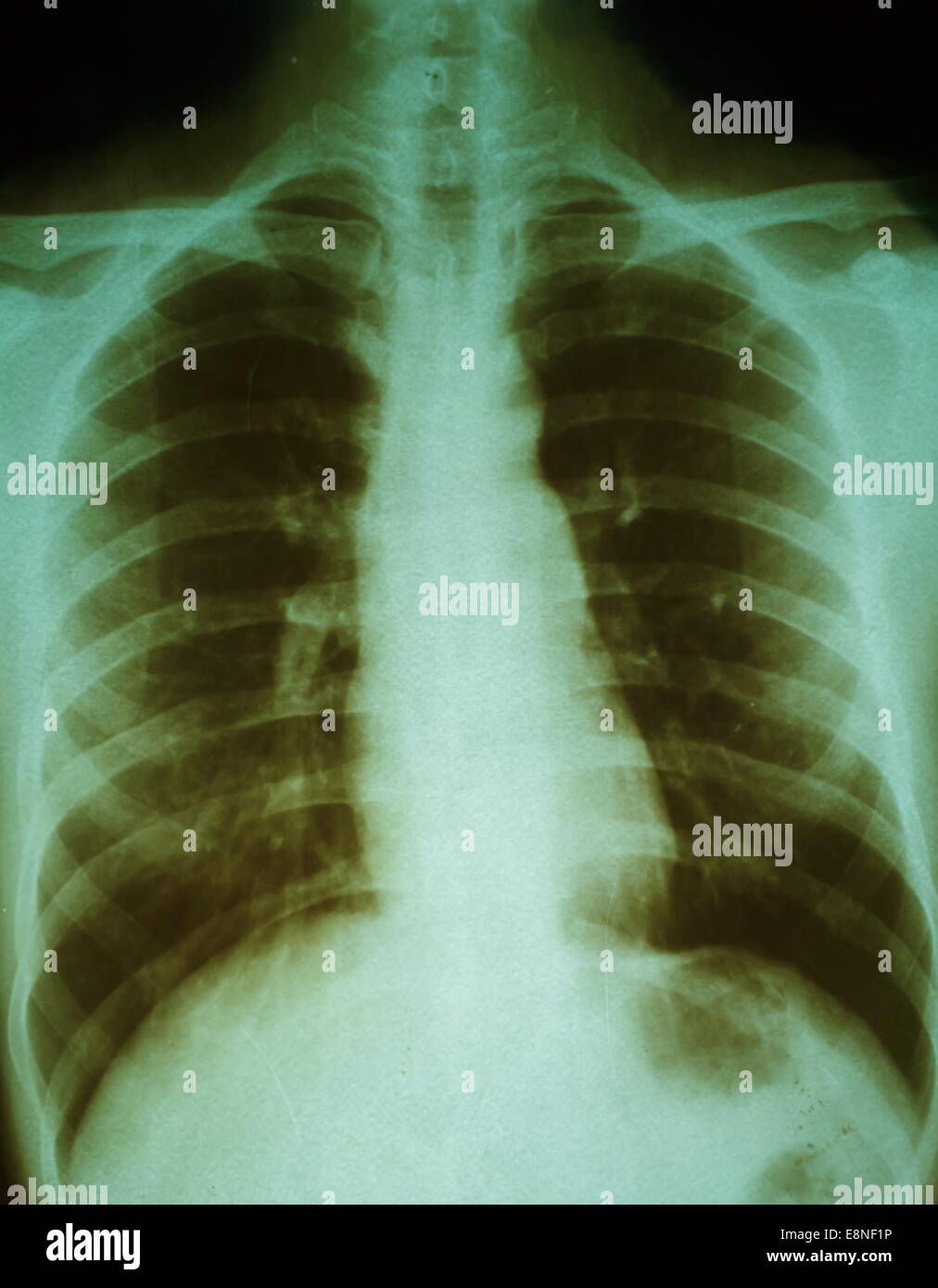 Chest Xray Copd