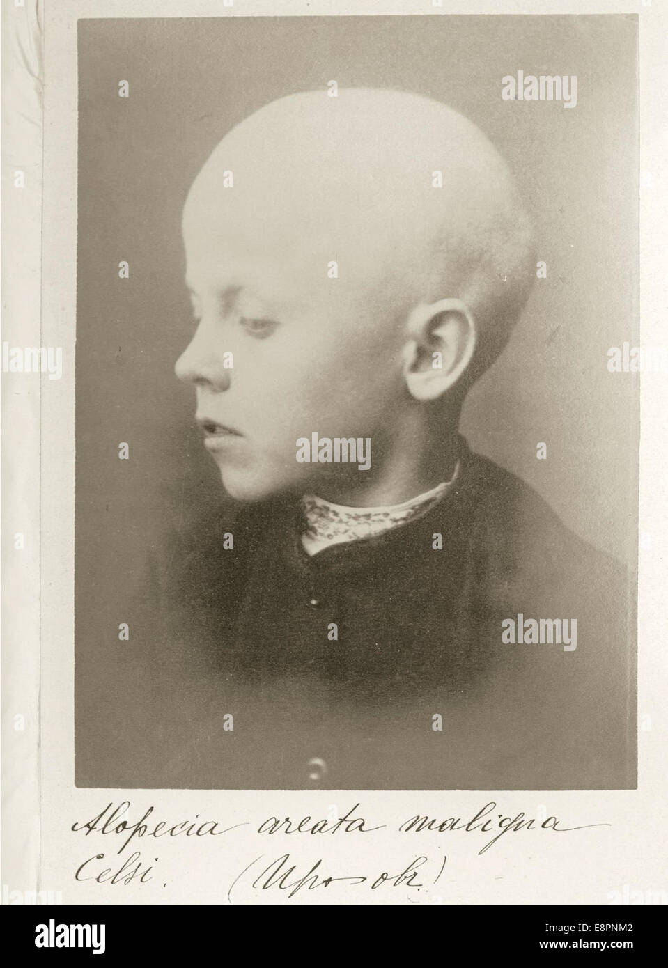 This historical photograph shows a nine-year-old boy suffering from ...