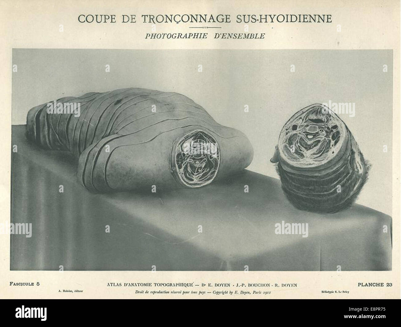 This image from Eugène-Louis Doyen's 'Atlas d'anatomie topographique ...