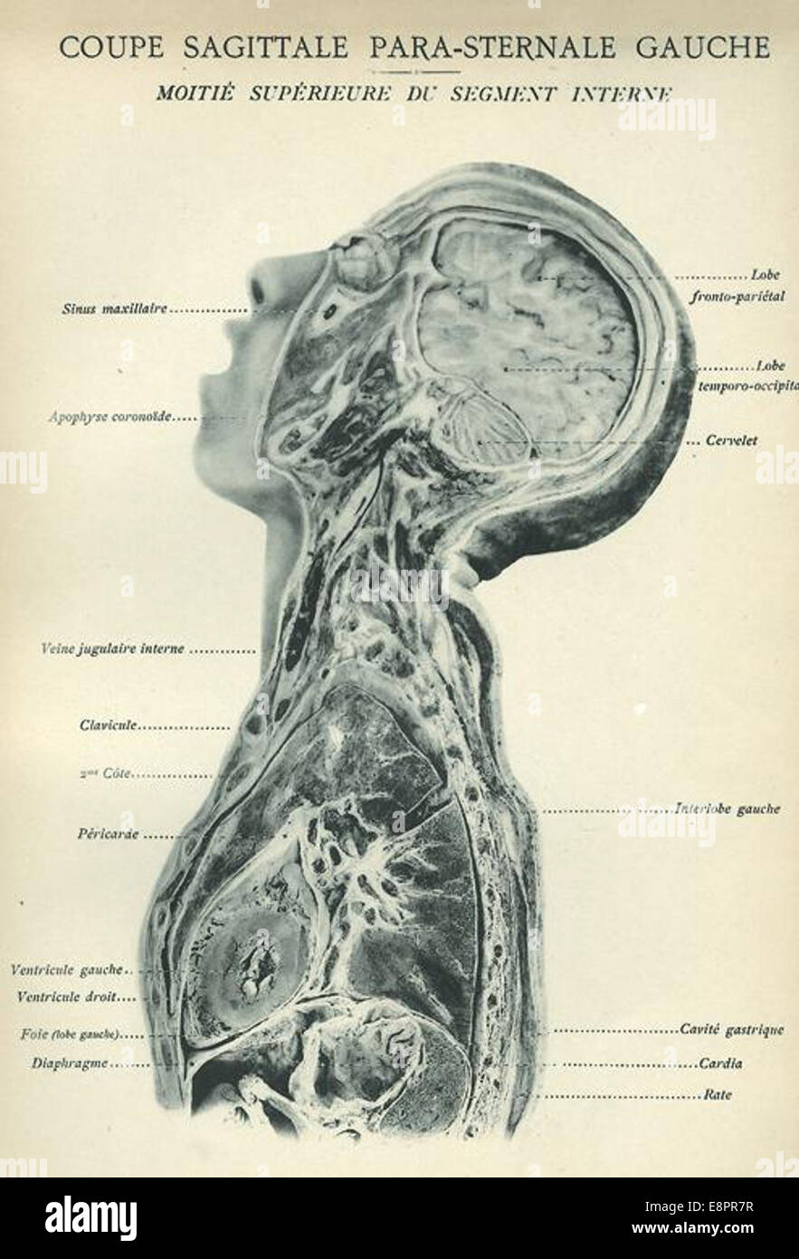 A medical illustration showing a sagittal cut of the left para-sternal ...