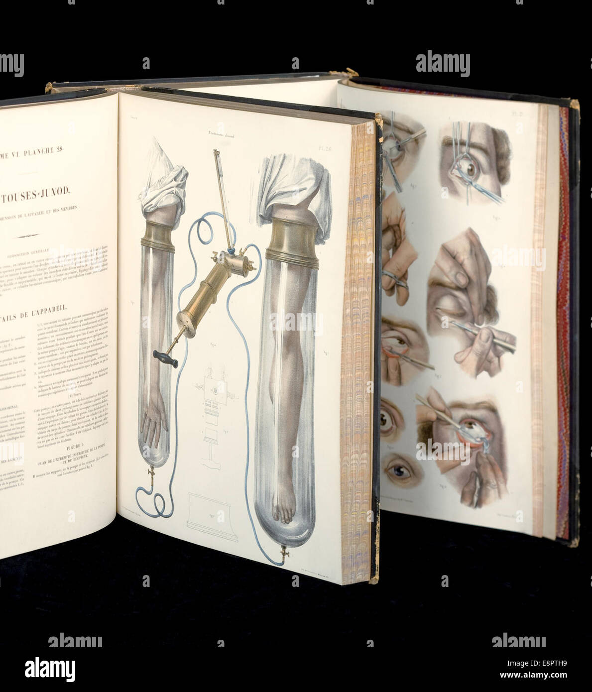 This image shows glass tubes and pumps used in eye surgery, likely part ...