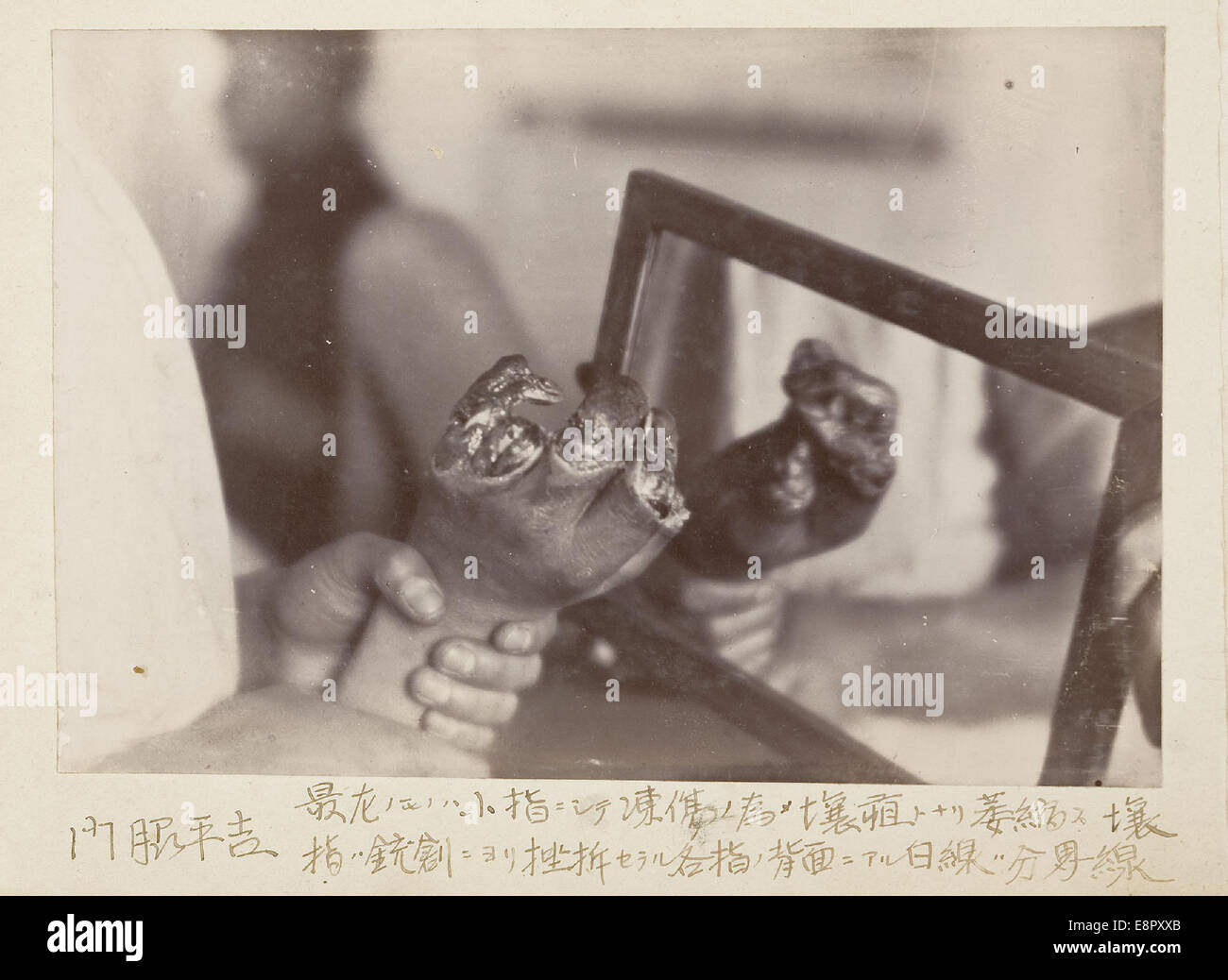 A photograph from a Russo-Japanese War album, showing severe frostbite ...