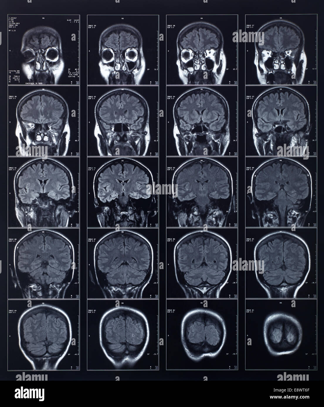 Brain xray hi-res stock photography and images - Alamy