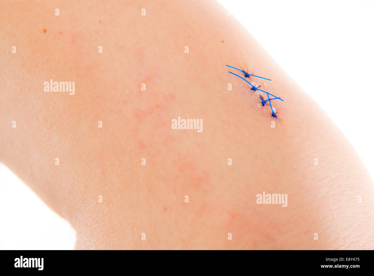 Injury stitches hi-res stock photography and images - Alamy