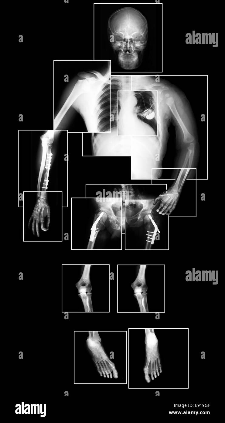 Human body ray scan anatomy hi-res stock photography and images - Alamy