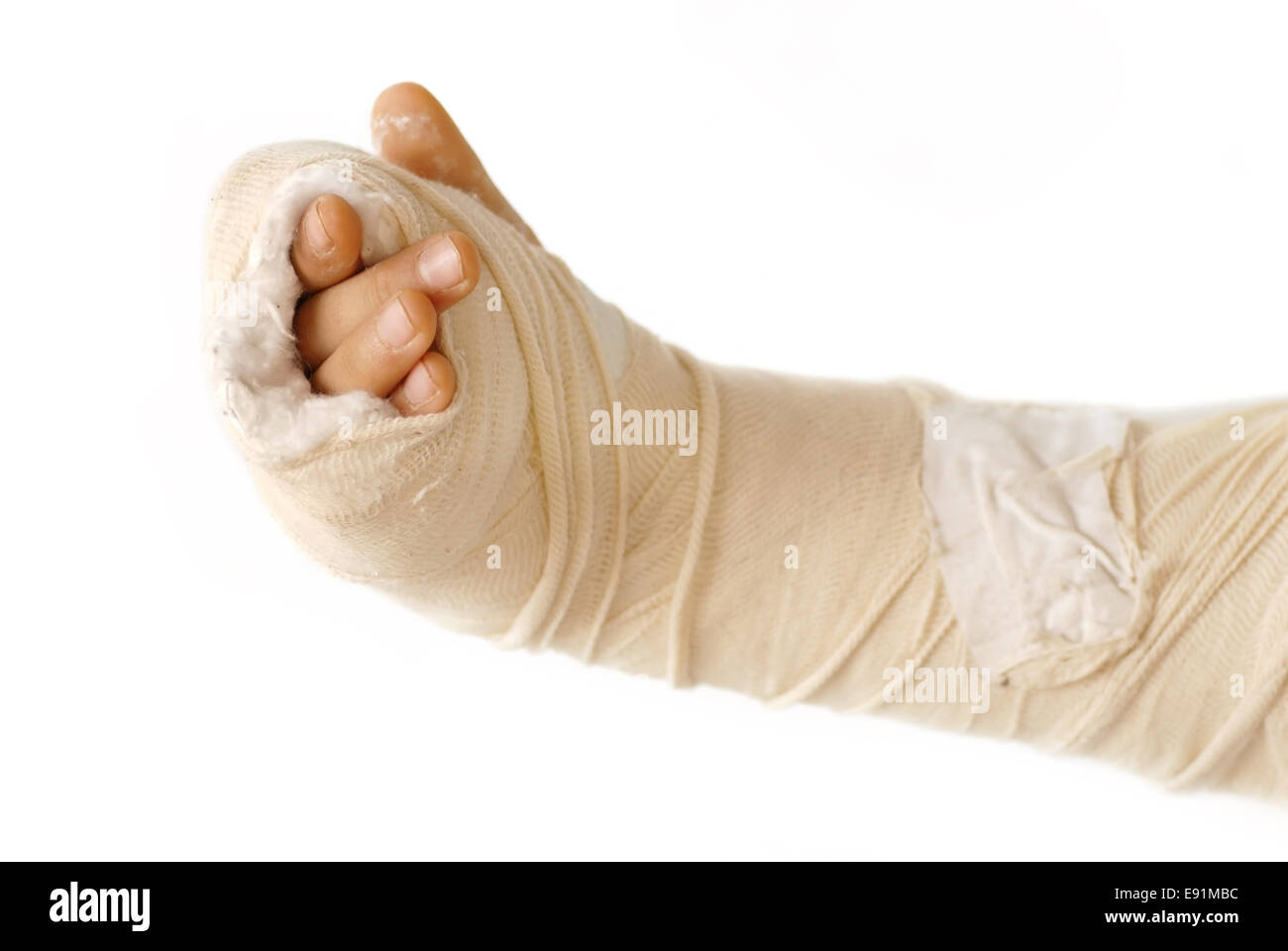 Broken arm hi-res stock photography and images - Alamy