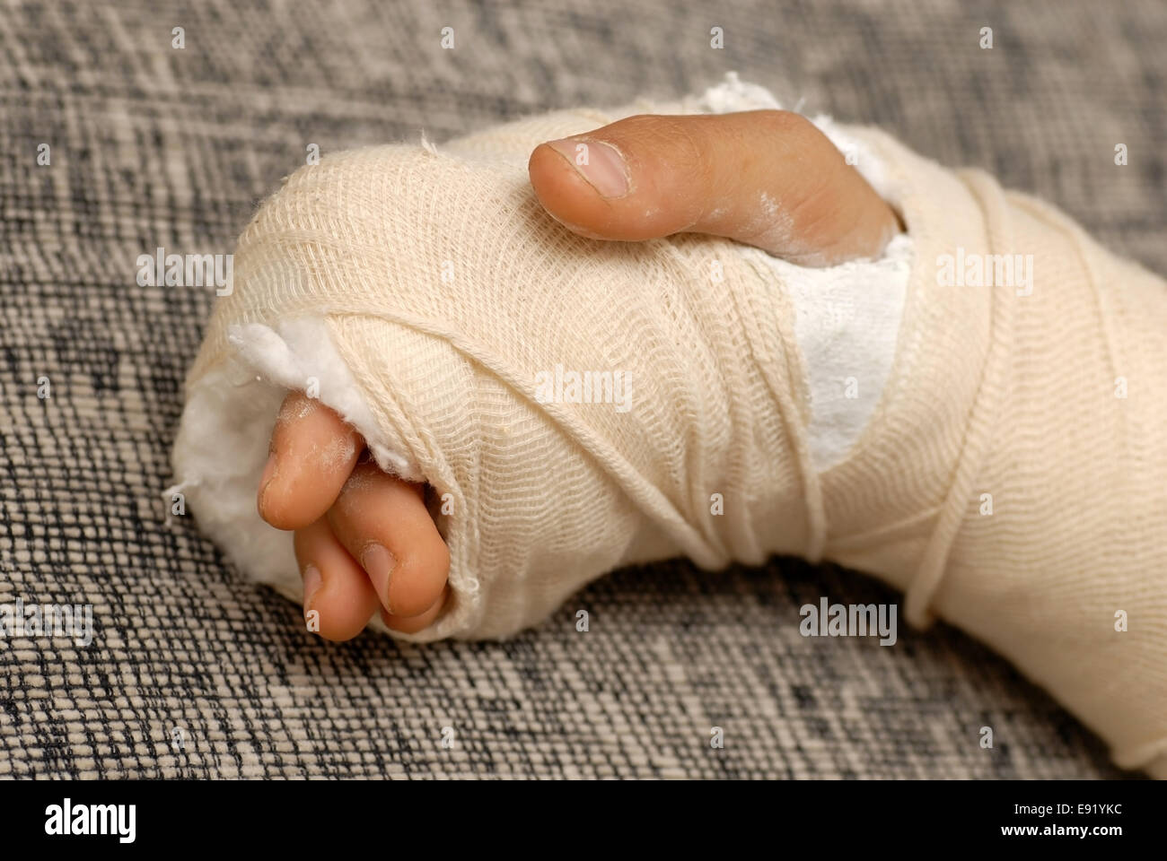 Broken Arm Stock Photos & Broken Arm Stock Images - Alamy