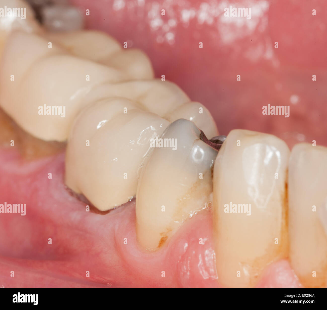 Gold filling teeth hi-res stock photography and images - Alamy