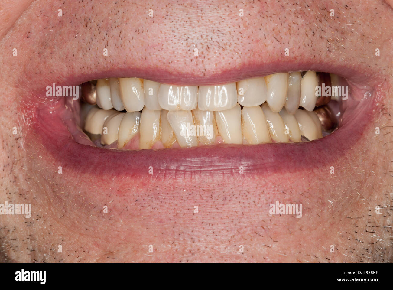 Composite teeth hi-res stock photography and images - Alamy