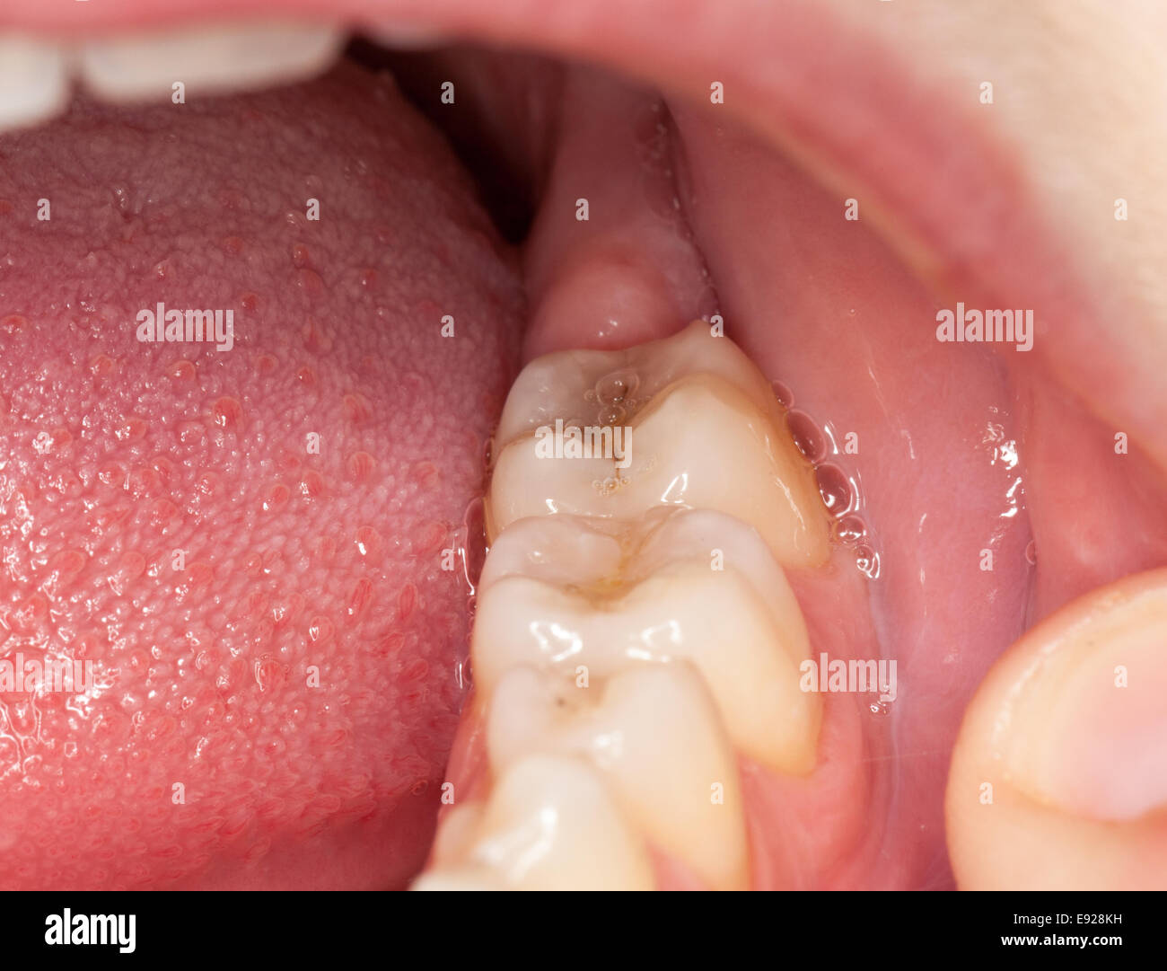 Amalgam filling teeth hi-res stock photography and images - Alamy