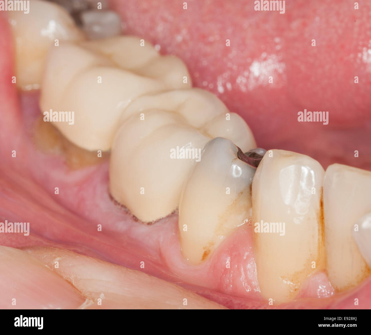 Gold filling teeth hi-res stock photography and images - Alamy